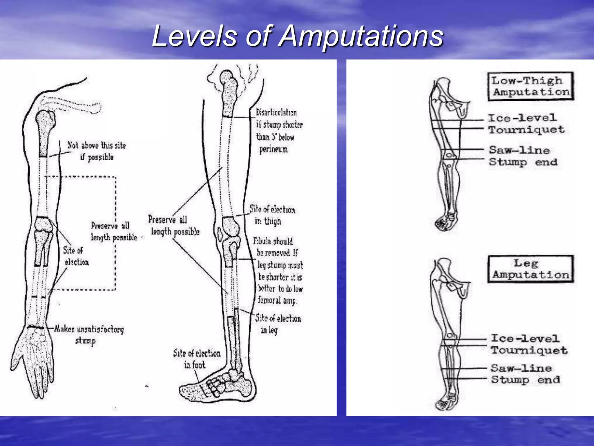Amputations and disarticulations in limbs.ppt