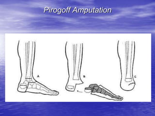 Amputations and disarticulations in limbs.ppt