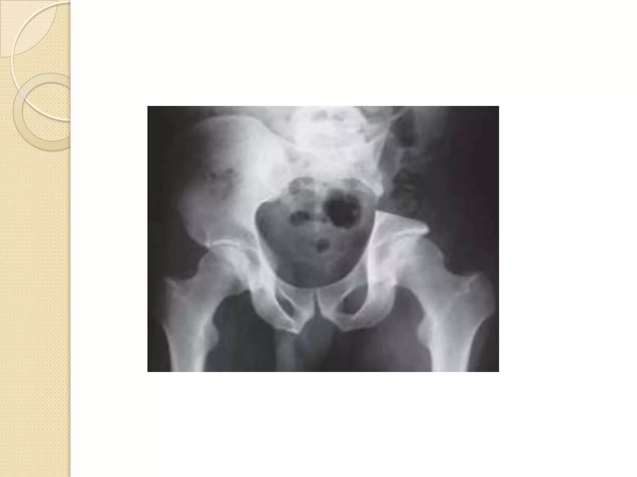 Amputations and hemipelvictomy | PPTX