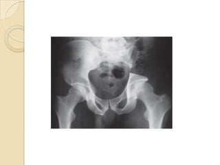 Amputations and hemipelvictomy | PPTX