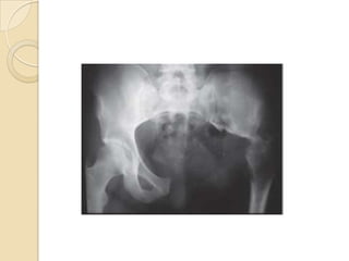 Amputations and hemipelvictomy | PPTX