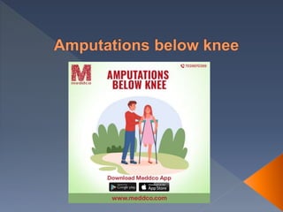 Amputations below knee | PPTX