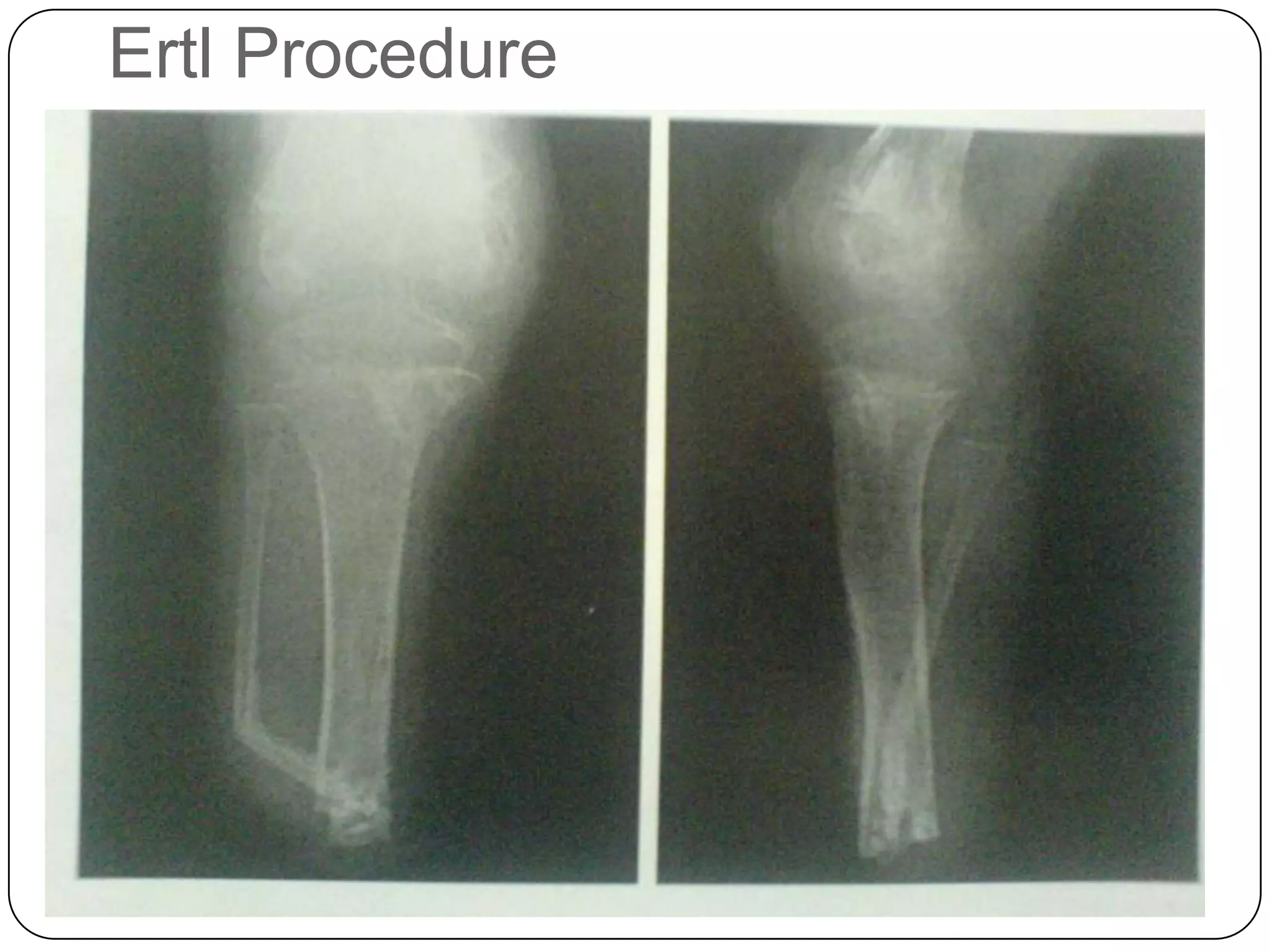 Amputations in children | PPTX