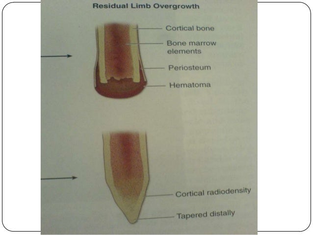 Amputations in children