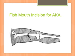 AMPUTATIONS IN LIMBS.pptx