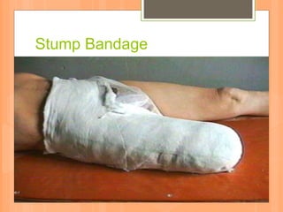 AMPUTATIONS IN LIMBS.pptx