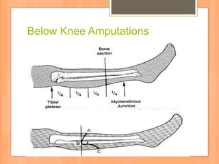 AMPUTATIONS IN LIMBS.pptx