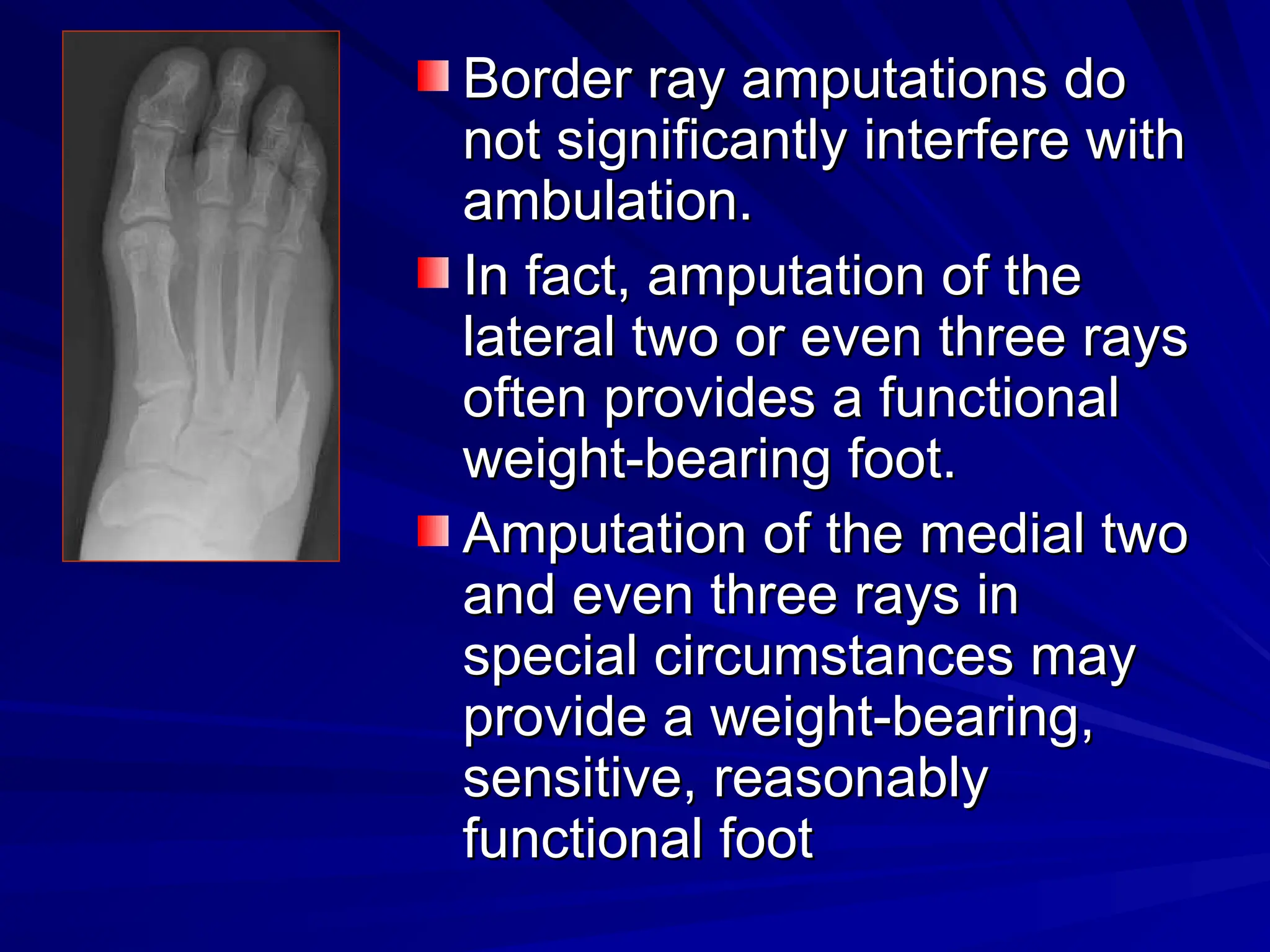 AMPUTATIONS OF FOOT.ppt for orthopaedic residents | PPT