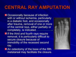 AMPUTATIONS OF FOOT.ppt for orthopaedic residents | PPT