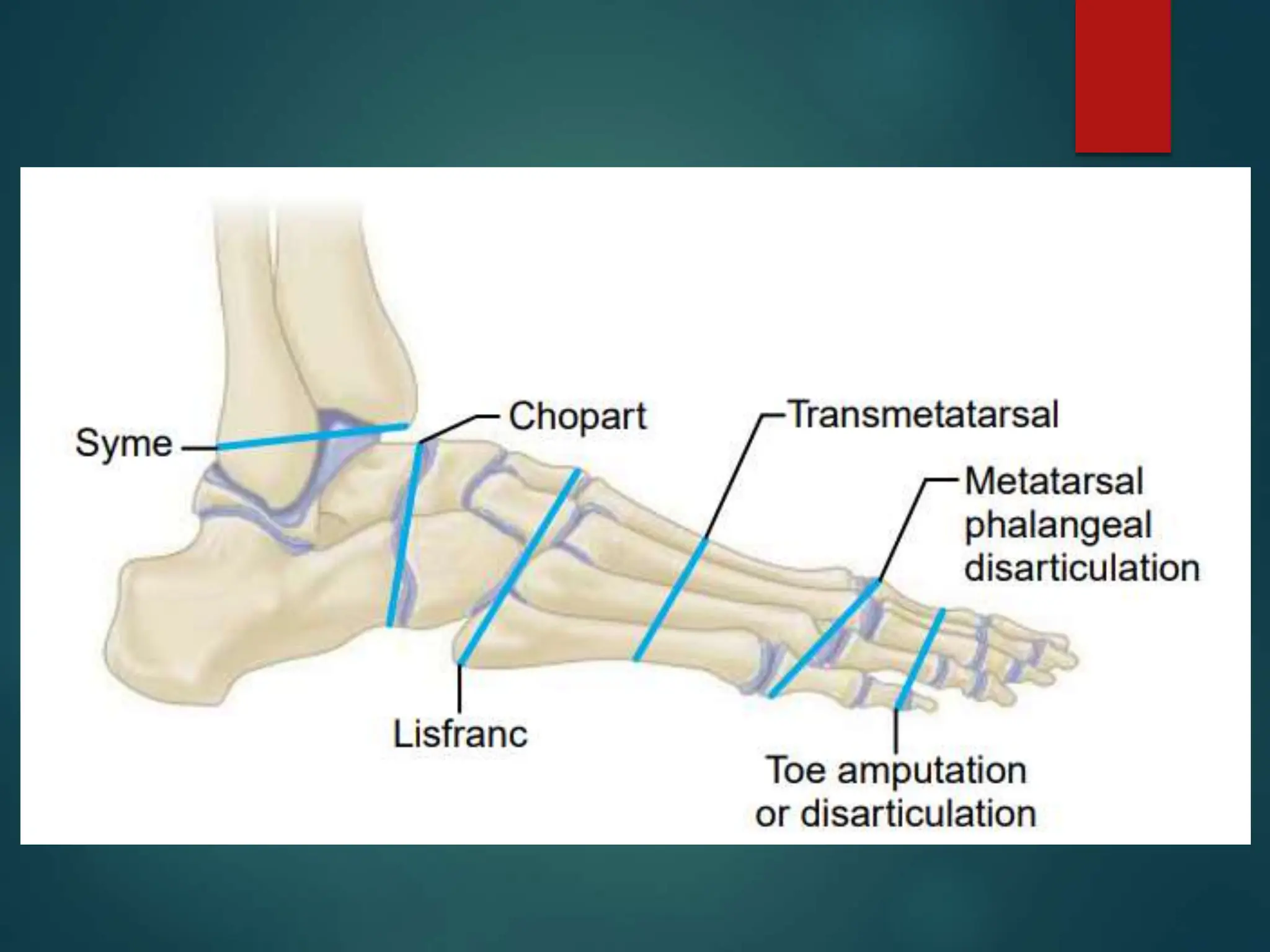 AMPUTATIONS OF LOWER LIMBS [Autosaved] copy.pptx