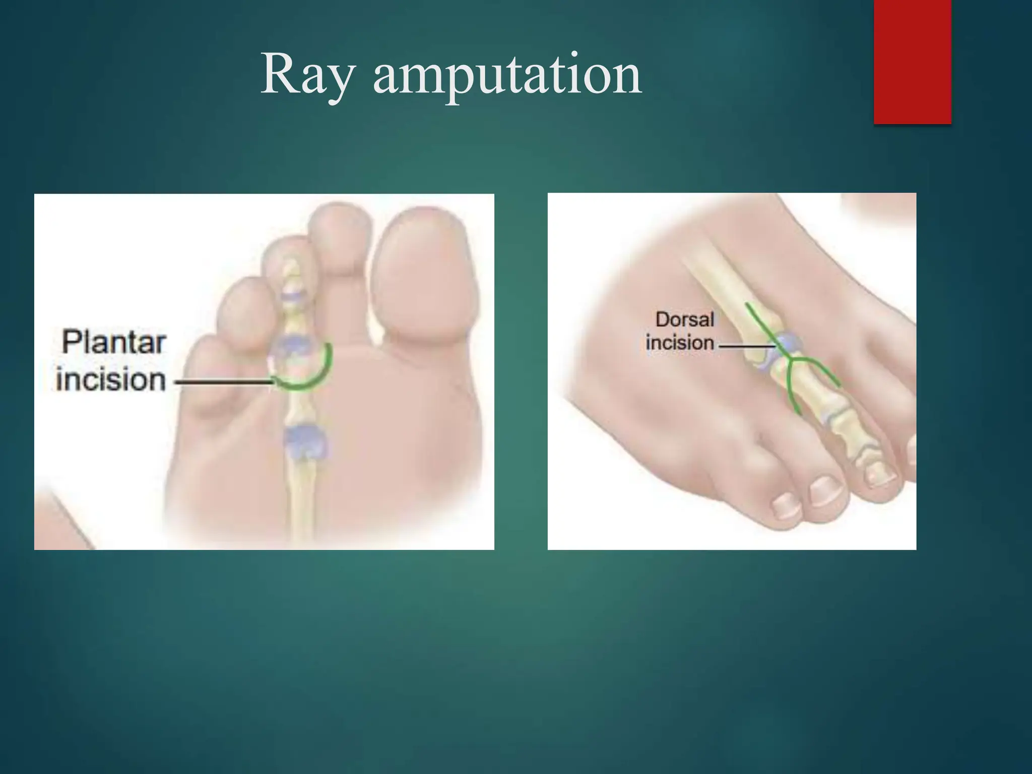 AMPUTATIONS OF LOWER LIMBS [Autosaved] copy.pptx