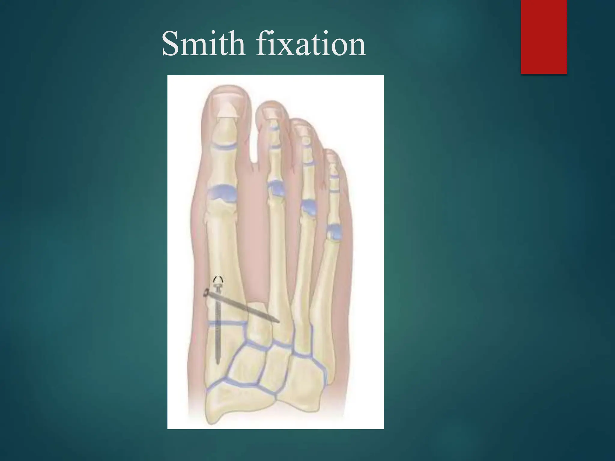 AMPUTATIONS OF LOWER LIMBS [Autosaved] copy.pptx