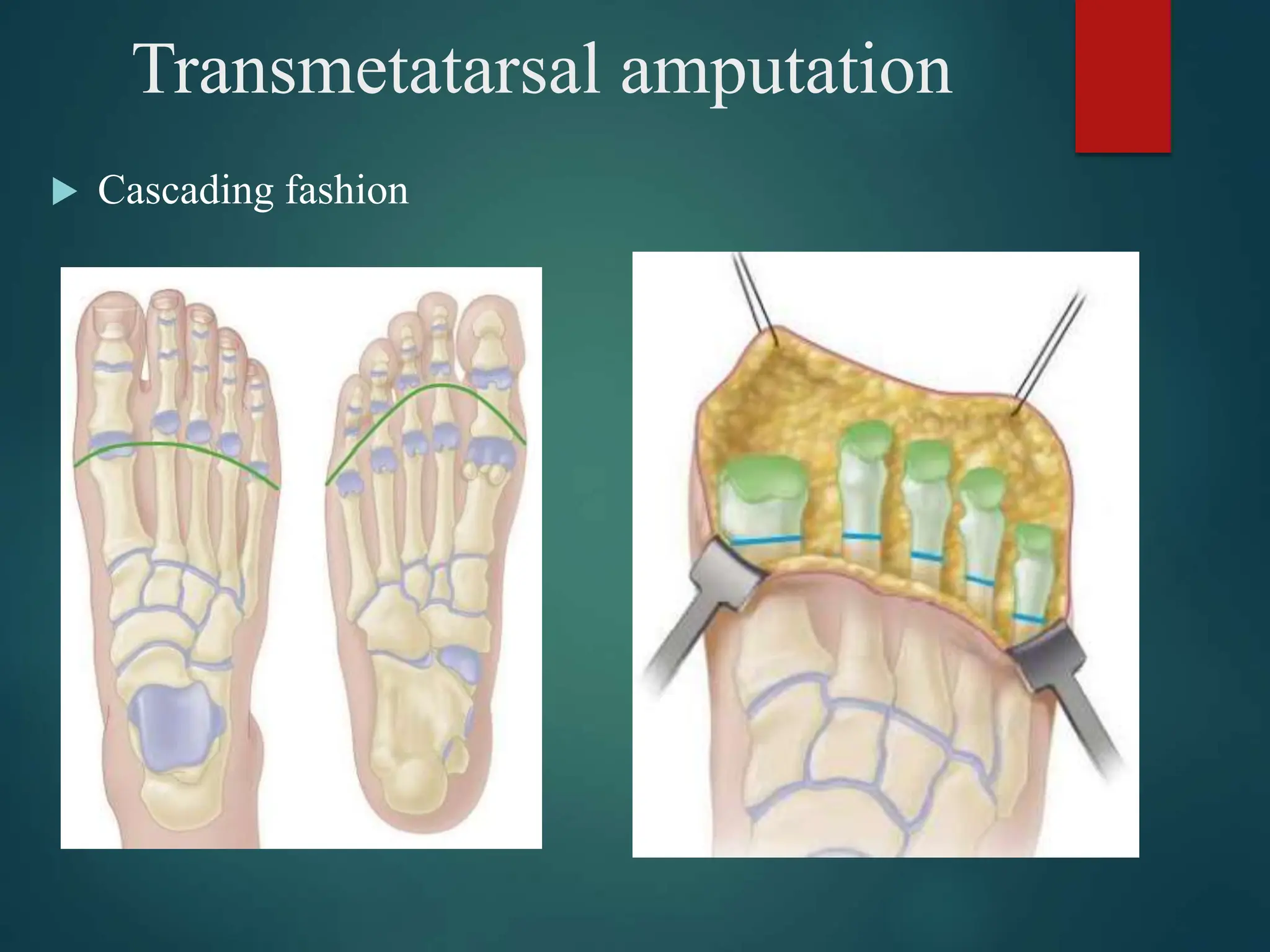 AMPUTATIONS OF LOWER LIMBS [Autosaved] copy.pptx