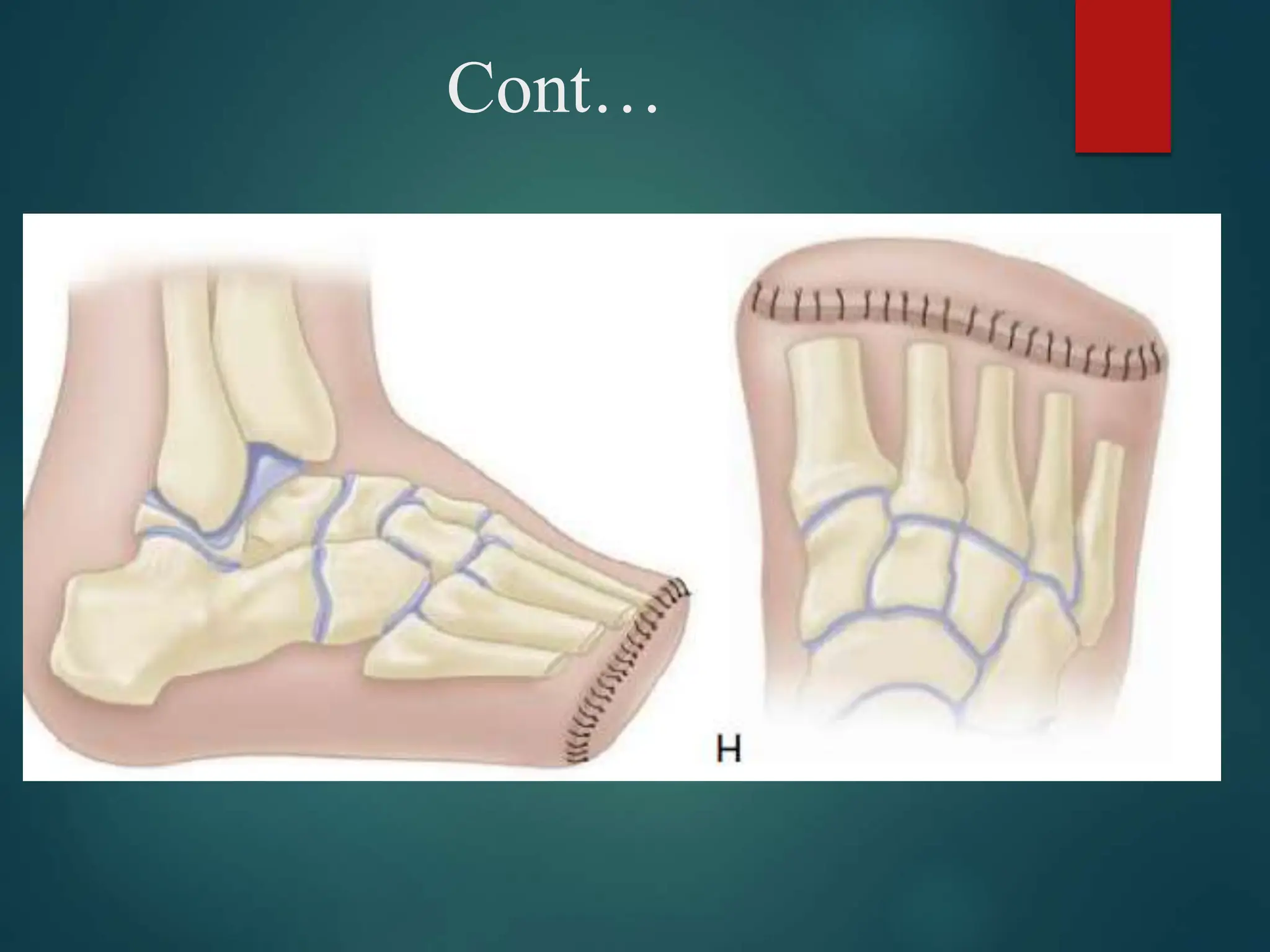 AMPUTATIONS OF LOWER LIMBS [Autosaved] copy.pptx
