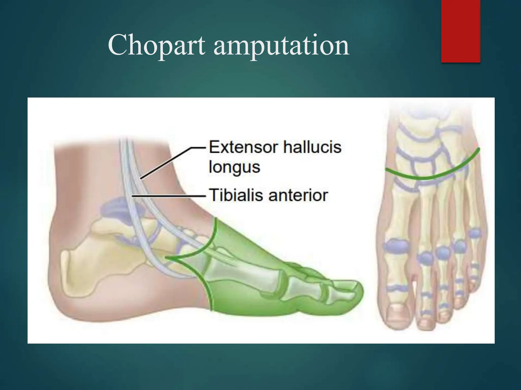 AMPUTATIONS OF LOWER LIMBS [Autosaved] copy.pptx