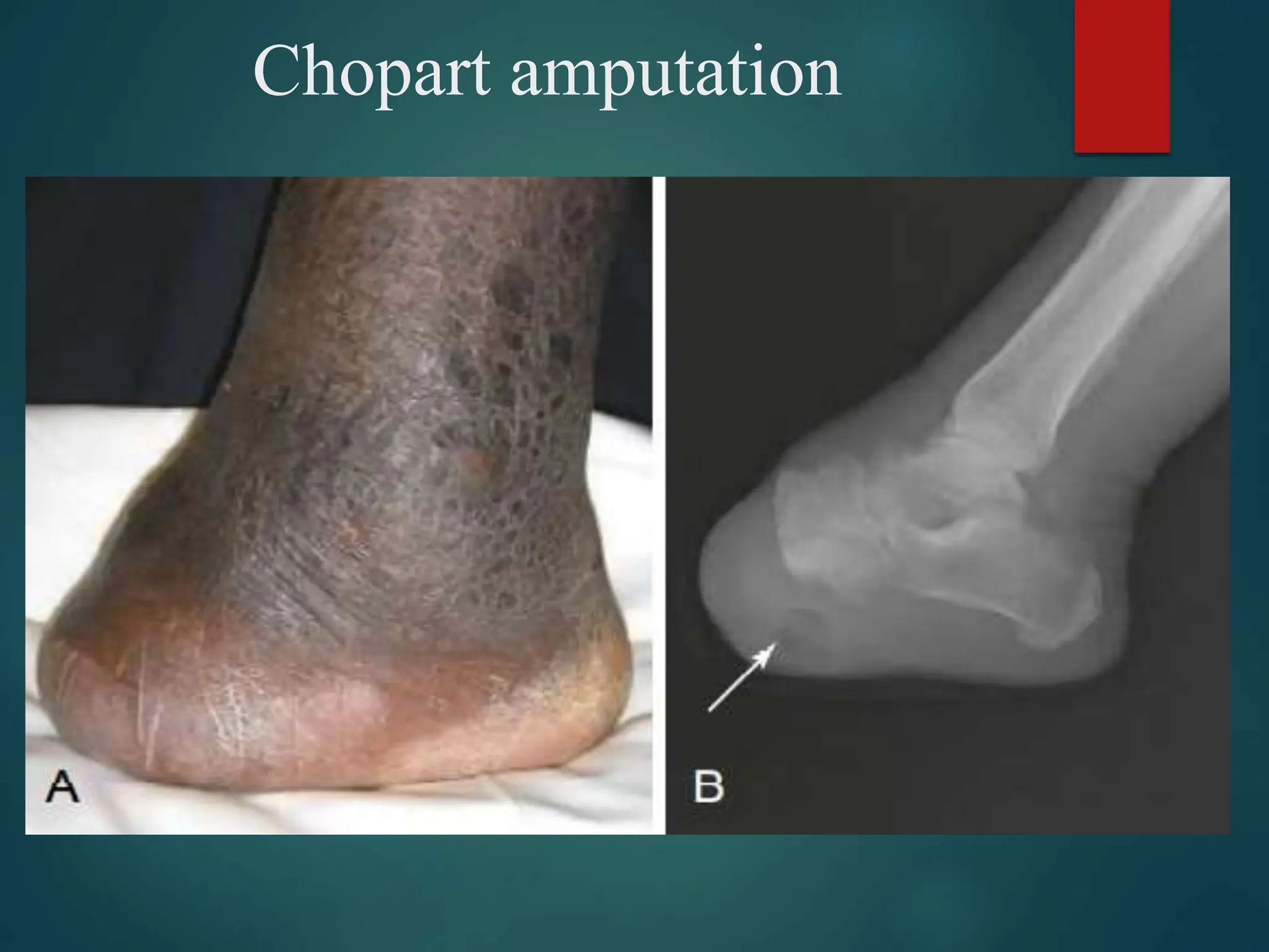 AMPUTATIONS OF LOWER LIMBS [Autosaved] copy.pptx