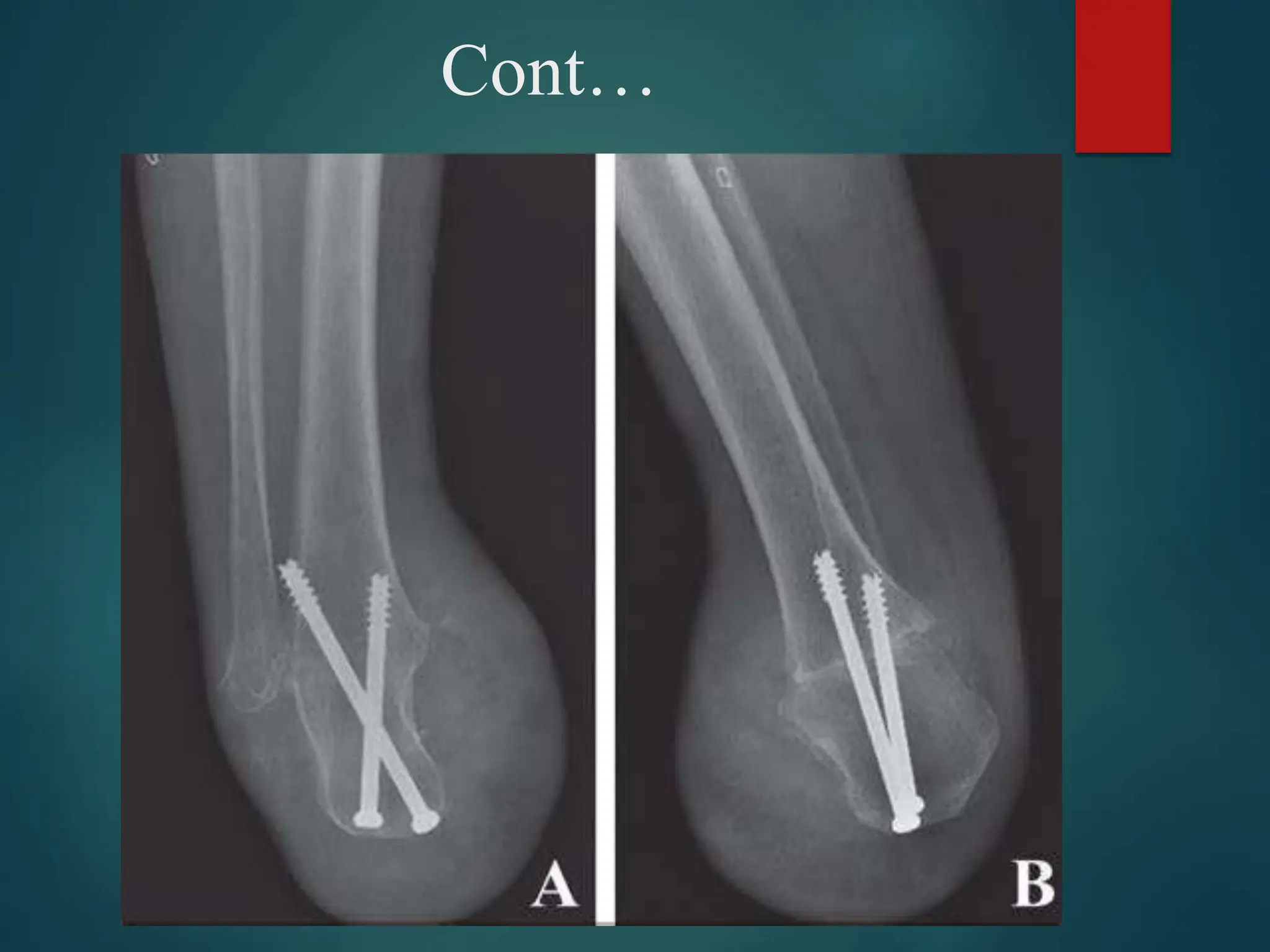 AMPUTATIONS OF LOWER LIMBS [Autosaved] copy.pptx