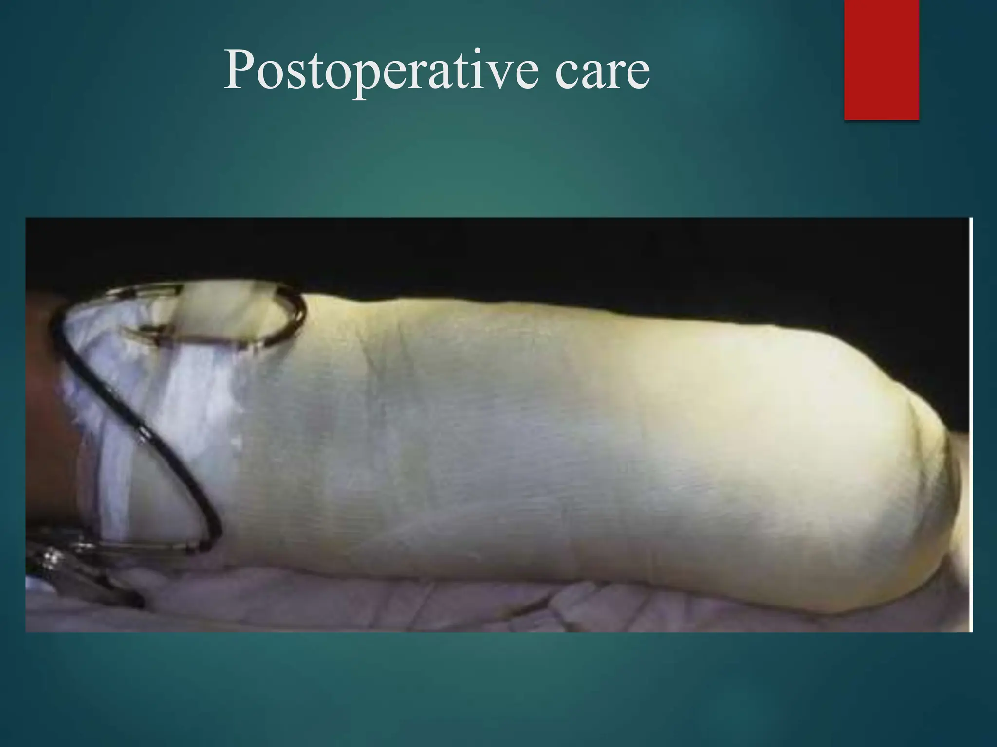 AMPUTATIONS OF LOWER LIMBS [Autosaved] copy.pptx