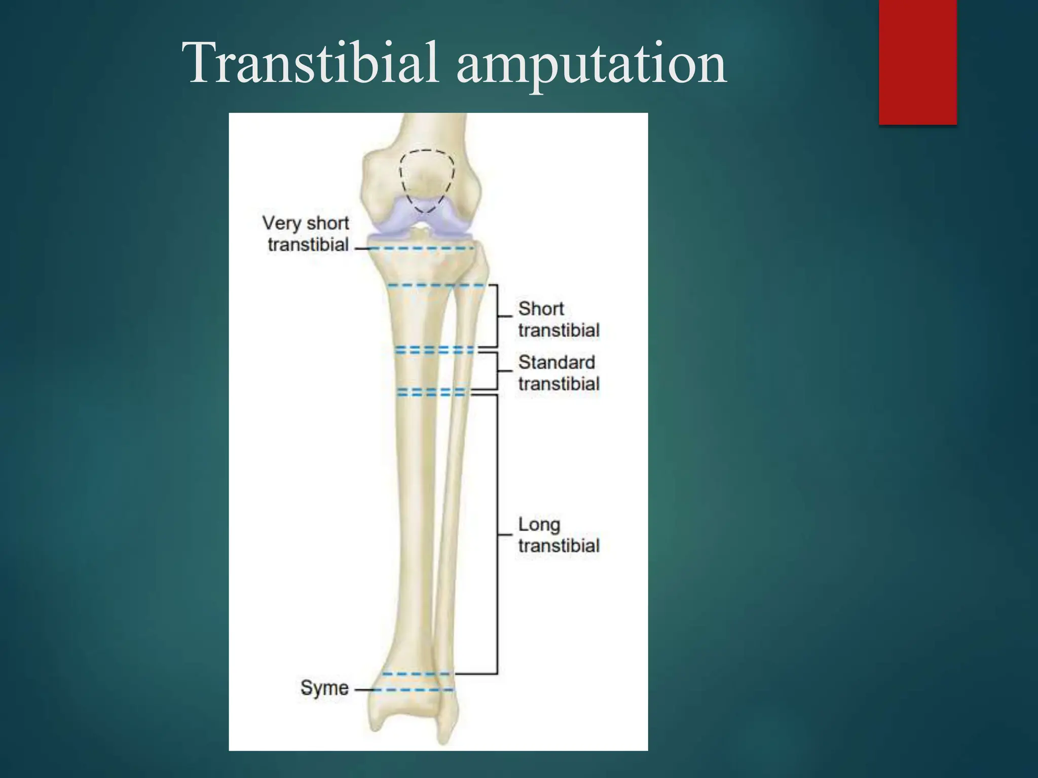 AMPUTATIONS OF LOWER LIMBS [Autosaved] copy.pptx