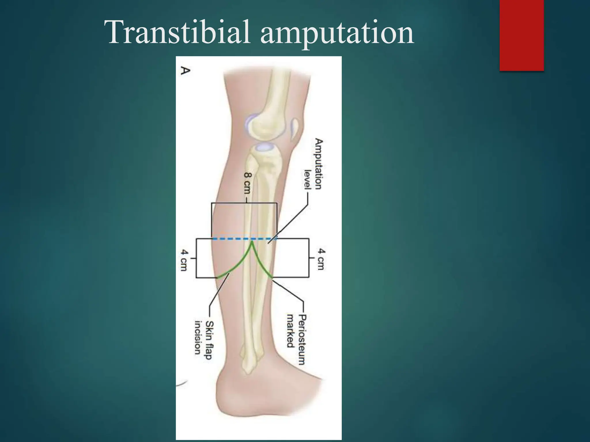 AMPUTATIONS OF LOWER LIMBS [Autosaved] copy.pptx