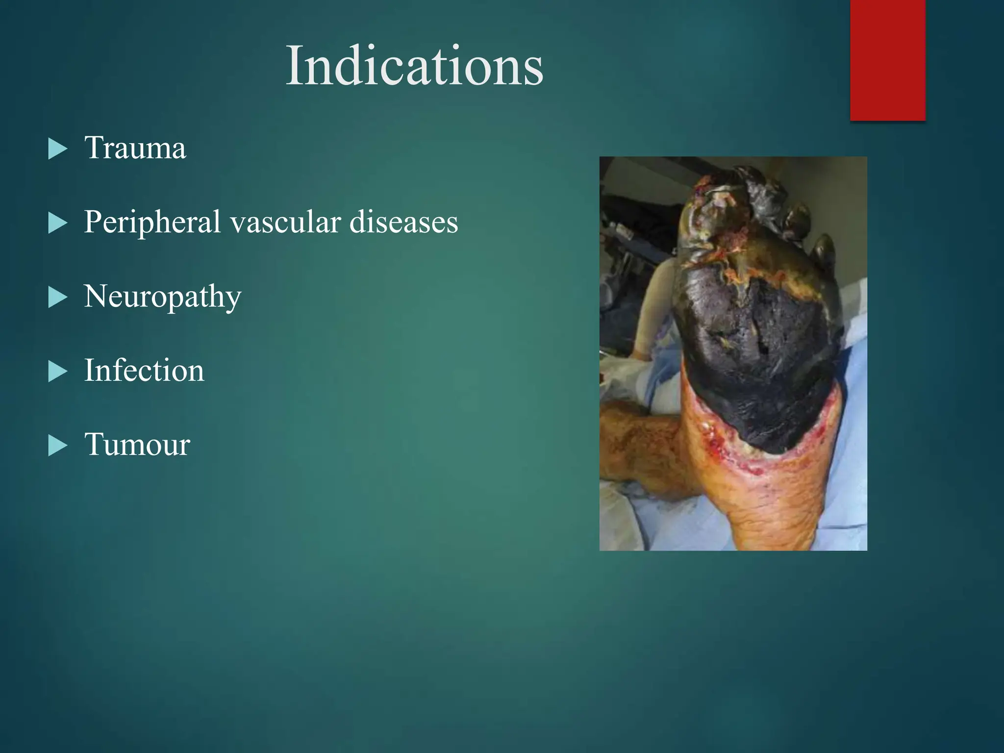 AMPUTATIONS OF LOWER LIMBS [Autosaved] copy.pptx