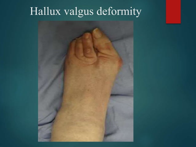 AMPUTATIONS OF LOWER LIMBS [Autosaved] copy.pptx