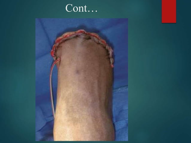 AMPUTATIONS OF LOWER LIMBS [Autosaved] copy.pptx