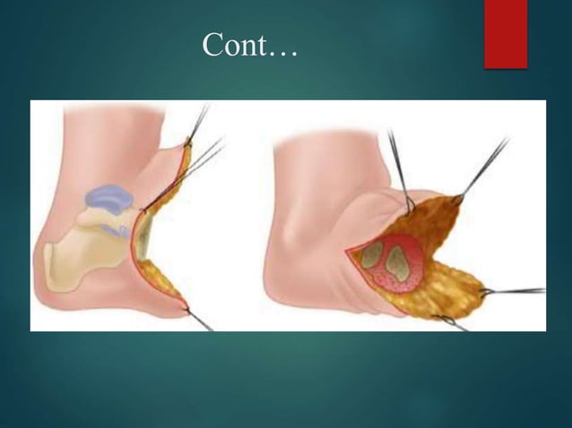AMPUTATIONS OF LOWER LIMBS [Autosaved] copy.pptx