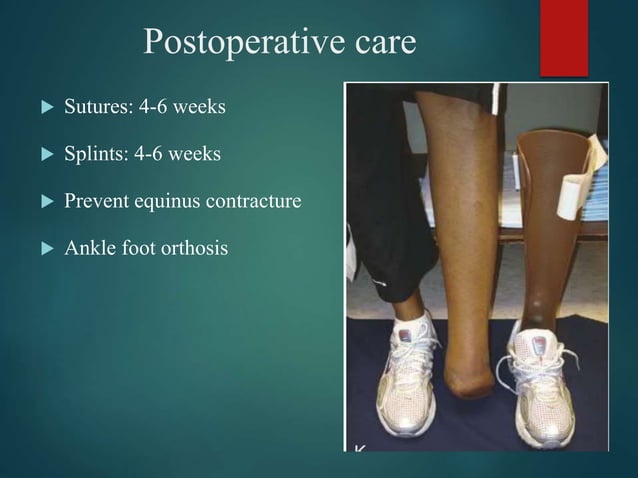 AMPUTATIONS OF LOWER LIMBS [Autosaved] copy.pptx