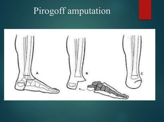 AMPUTATIONS OF LOWER LIMBS [Autosaved] copy.pptx
