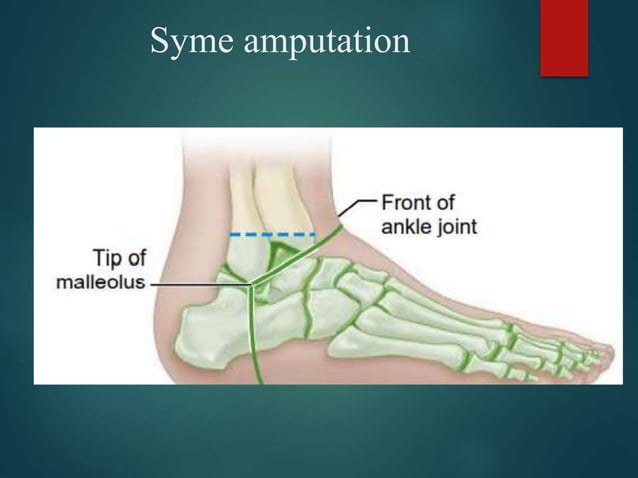 AMPUTATIONS OF LOWER LIMBS [Autosaved] copy.pptx