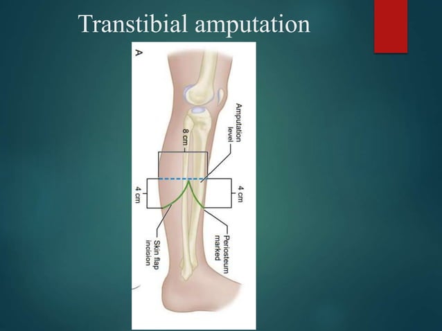 AMPUTATIONS OF LOWER LIMBS [Autosaved] copy.pptx
