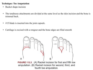Amputations pdf | PPT