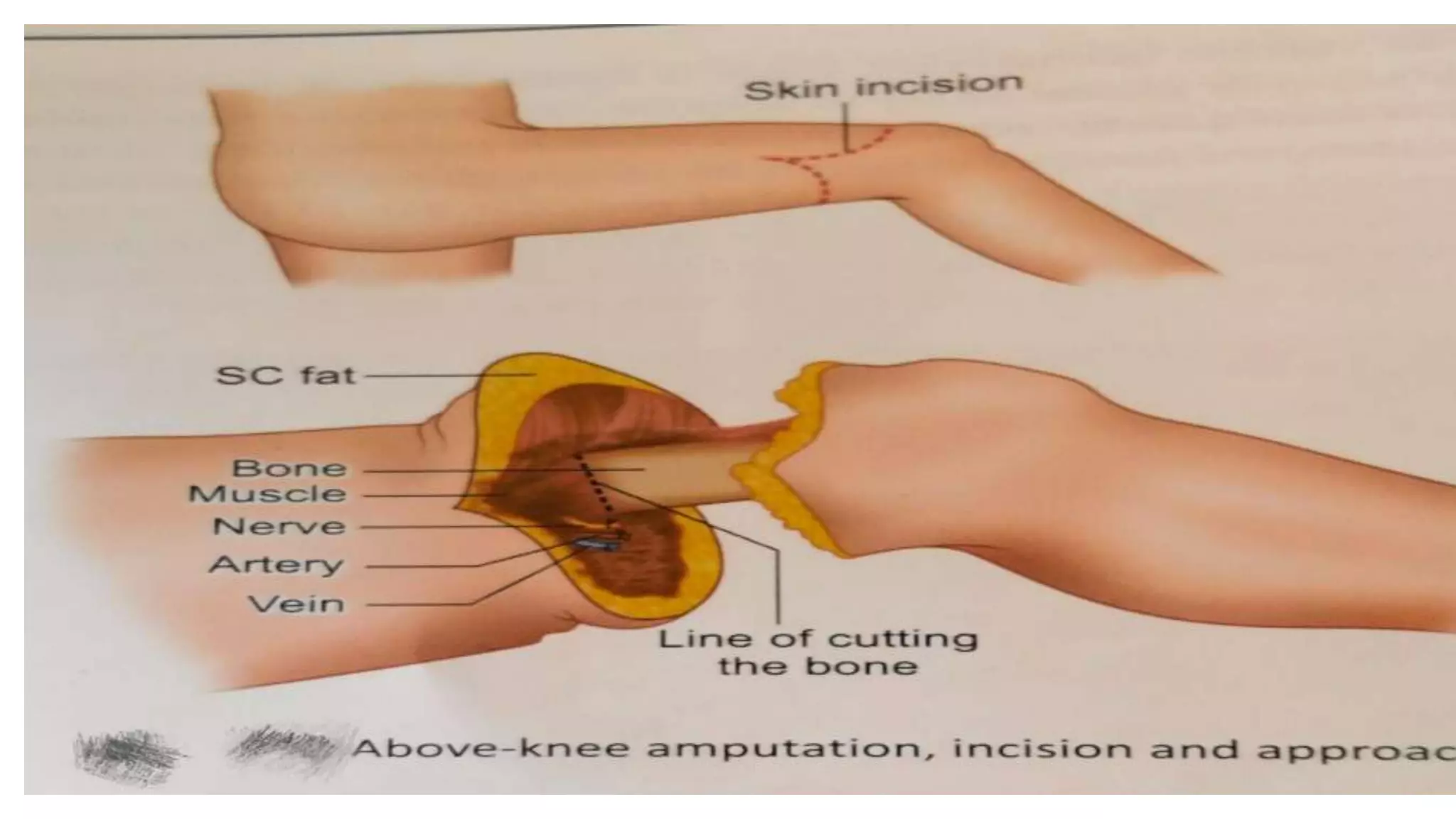 AMPUTATIONS ppt.pptx