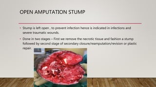 Amputation stump | PPTX | First Aid | Injuries