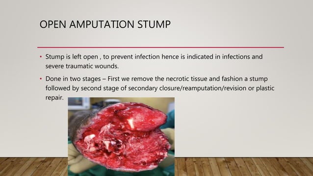 Amputation stump | PPTX | First Aid | Injuries