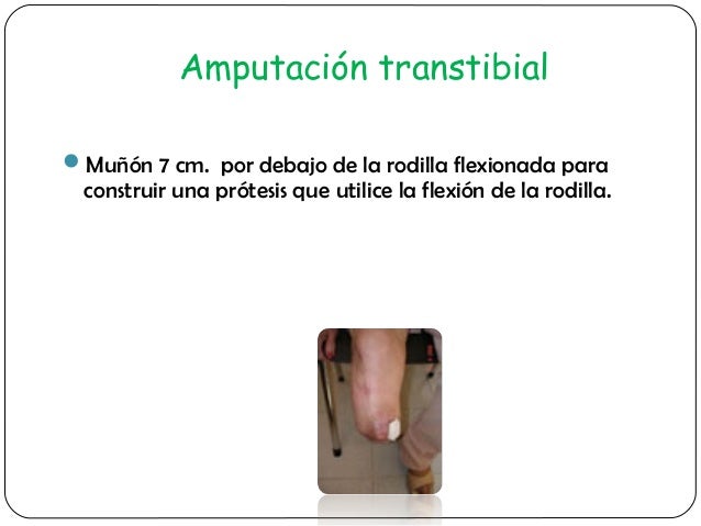 Amputación Infracondilea Protesis Rehabilitacion