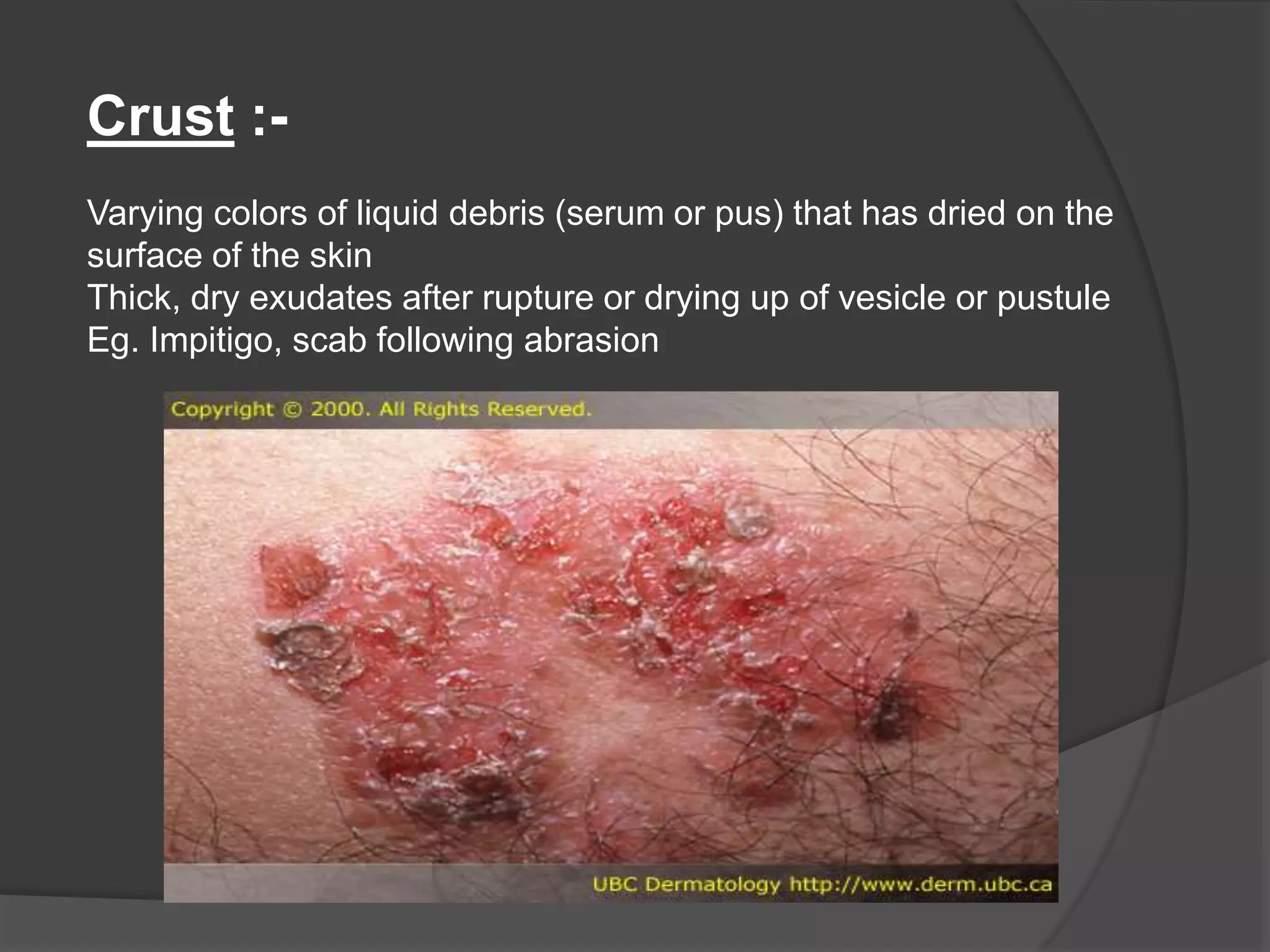classification of lesion | PPTX
