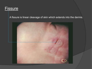 classification of lesion | PPTX