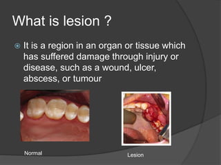classification of lesion | PPTX