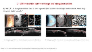 clinical application of OCT-A in anterior segment of the eye | PPTX
