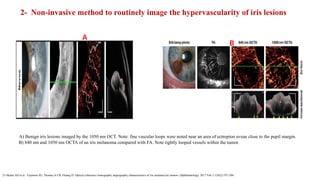 clinical application of OCT-A in anterior segment of the eye | PPTX