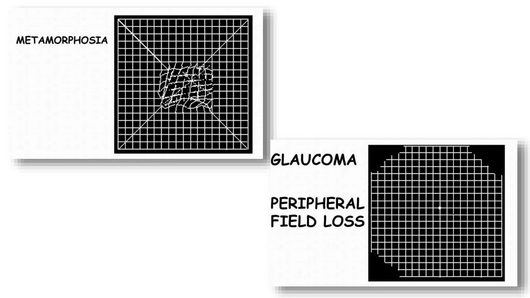 Amsler grid chart | PPTX