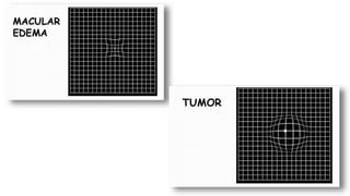 Amsler grid chart | PPTX