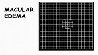Amsler grid | PPT