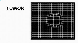 Amsler grid | PPT