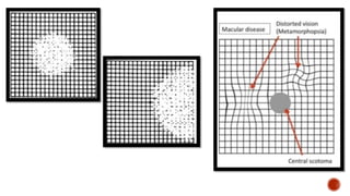 Amsler grid | PPTX