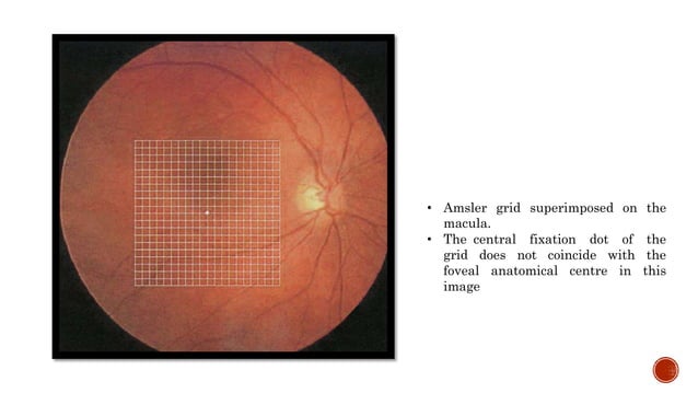 Amsler grid | PPTX