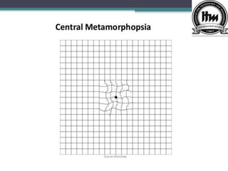 Abnormal Amsler Grid