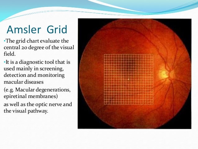 Amsler Grid Types Procedure Of Testing And Clinical Indications Amsler Grid Types Procedure Of Testing And Clinical Indications